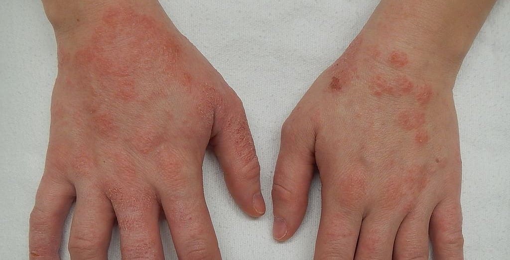 The curse of severe eczema may be coming to an end - Liberty Unyielding